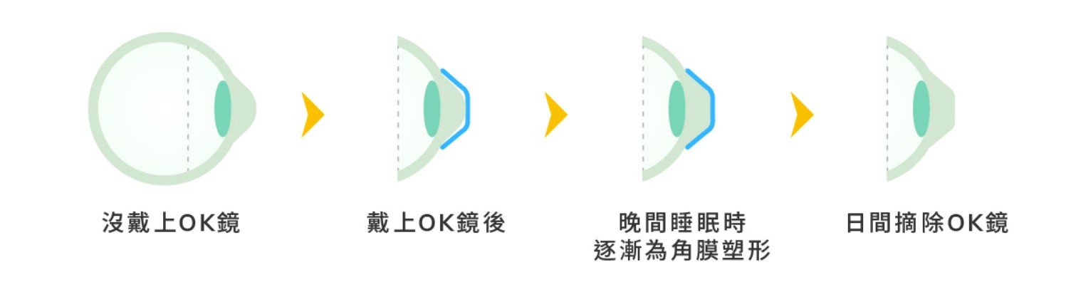 OK鏡有無用？OK鏡原理、成效、價錢&常見問題解答 - 幸福予你